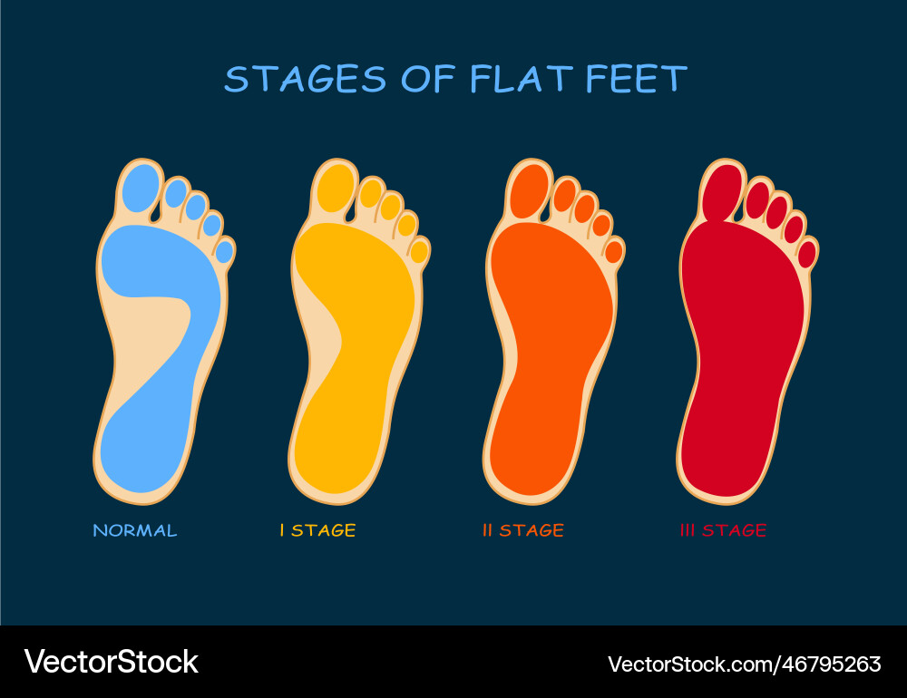 Stages of flat feet Royalty Free Vector Image - VectorStock