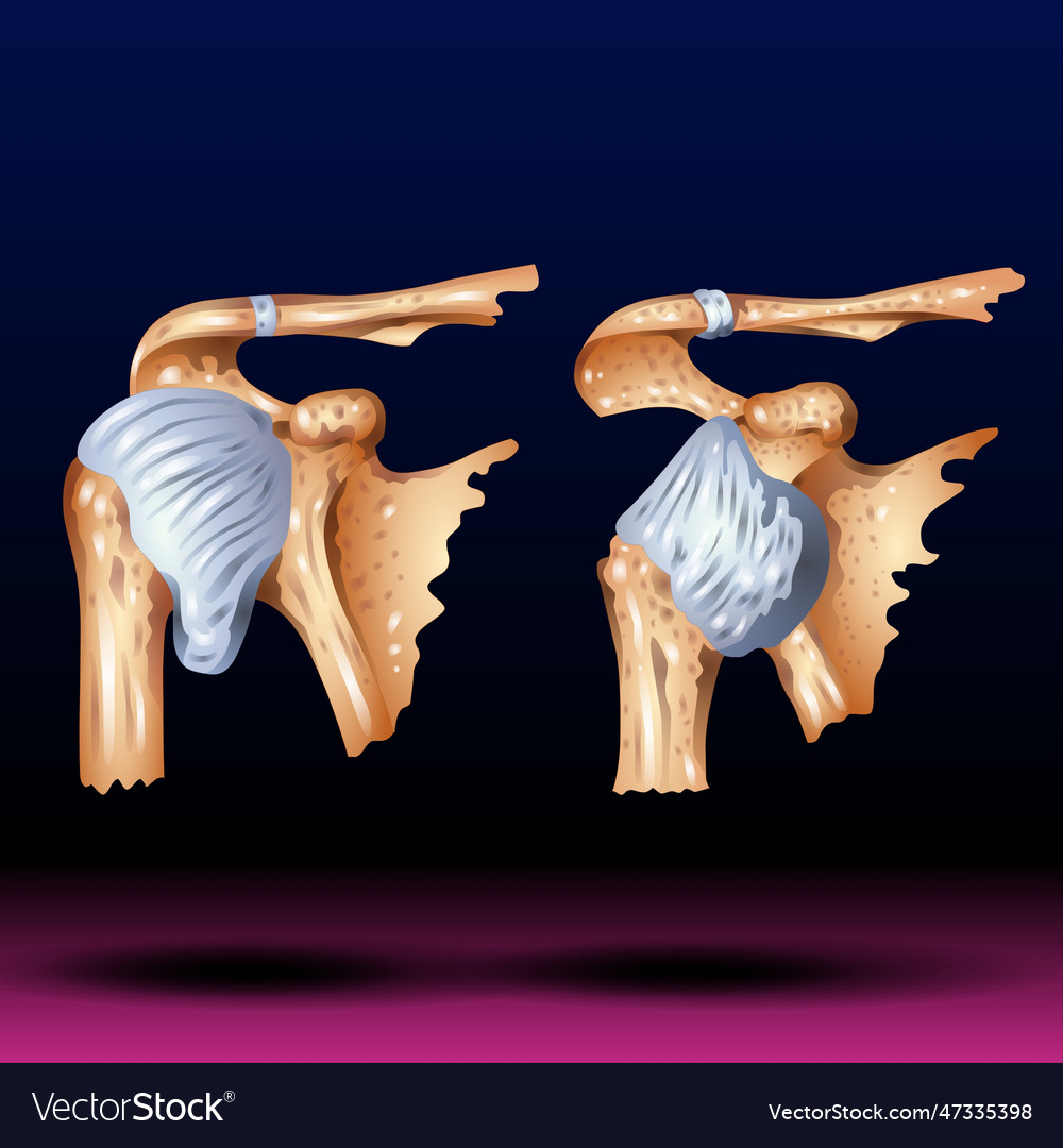 Shoulder dislocation Royalty Free Vector Image