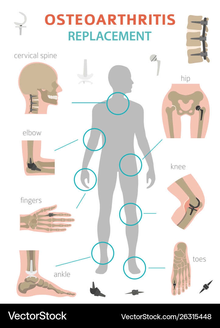 Arthritis osteoarthritis medical infographic Vector Image