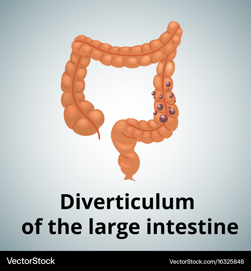 Realistic human sick colon isolated on white Vector Image