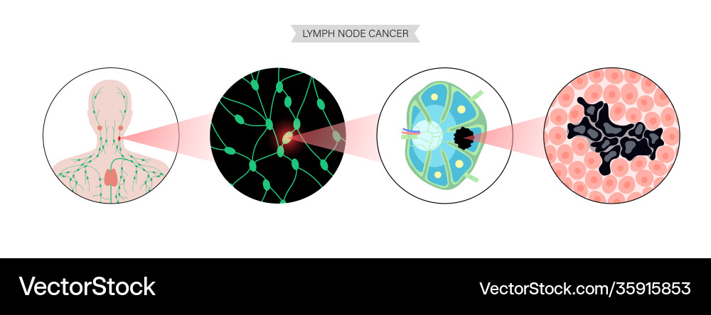 Lymphoma cancer concept Royalty Free Vector Image