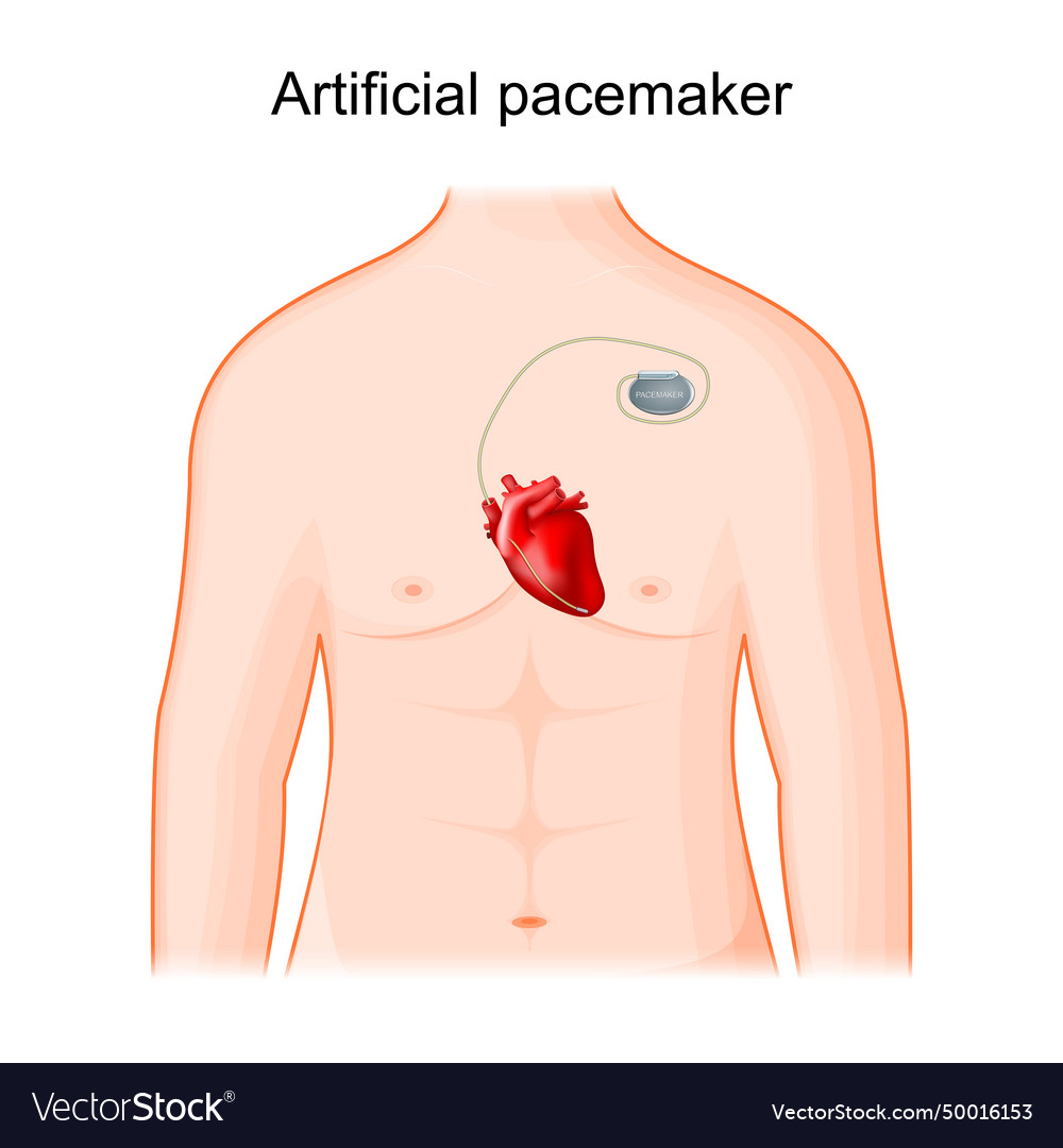 Artificial cardiac pacemaker human heart Vector Image