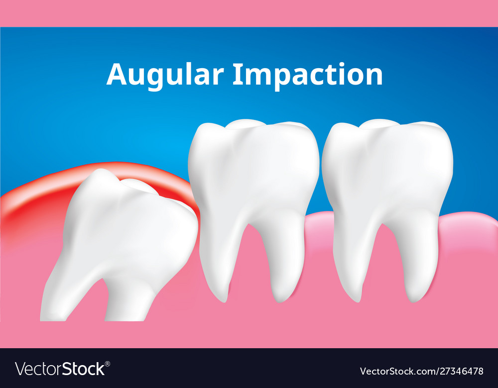 Wisdom tooth angular or mesial impaction Vector Image