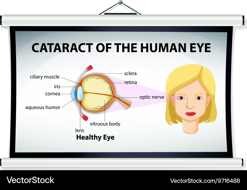 Diagram cataract in human eye Royalty Free Vector Image