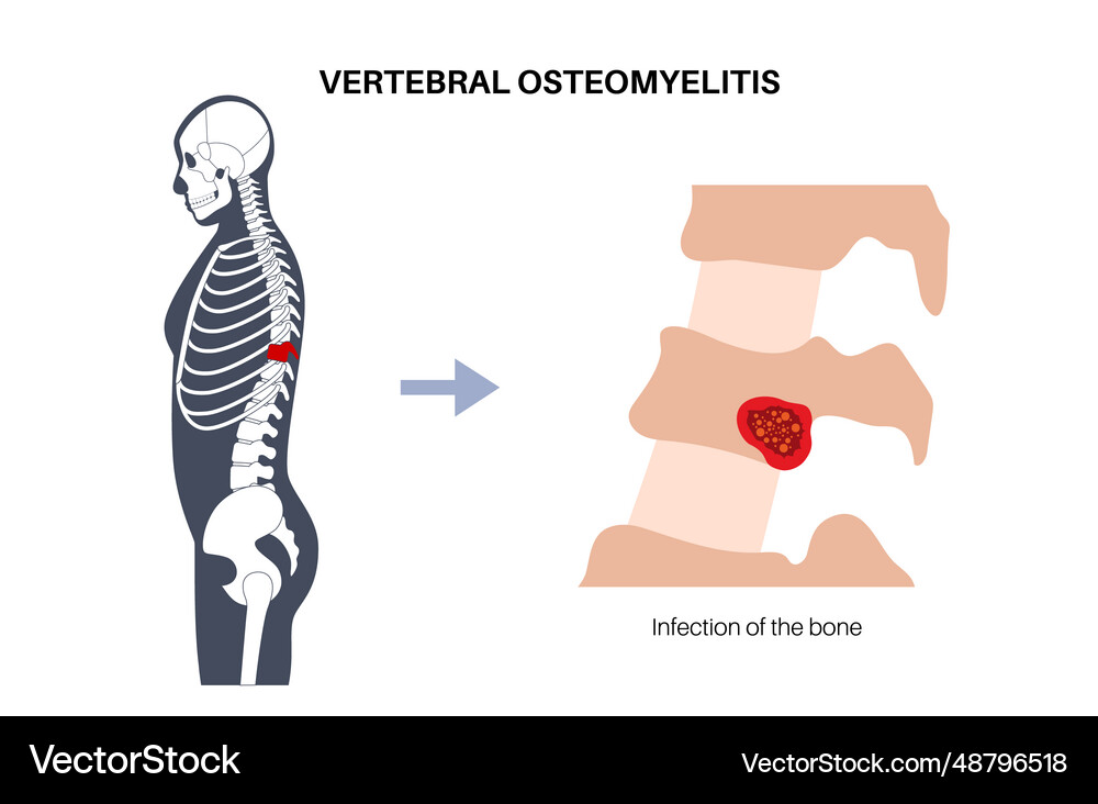 Vertebral Osteomyelitis - Infection and Sequestrum