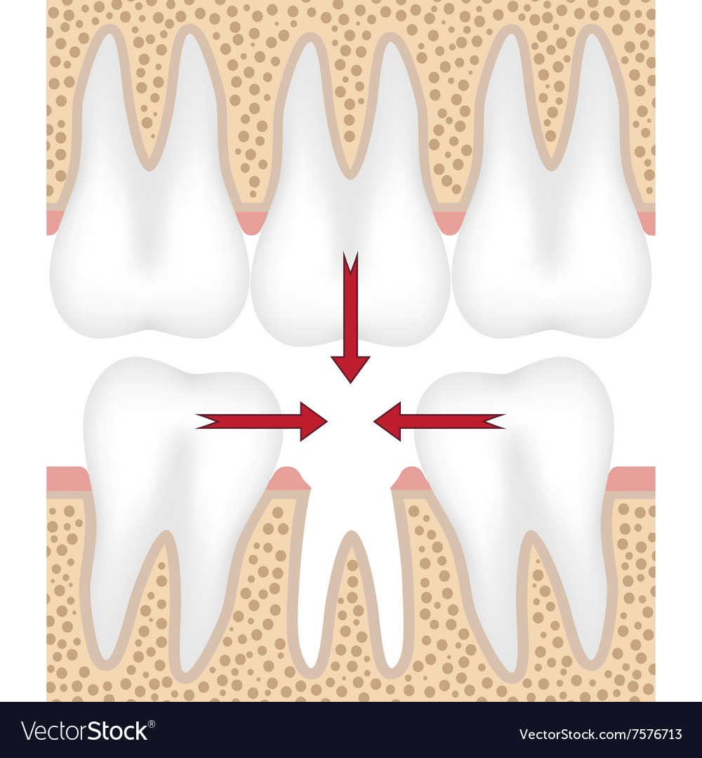 Missing tooth Royalty Free Vector Image - VectorStock