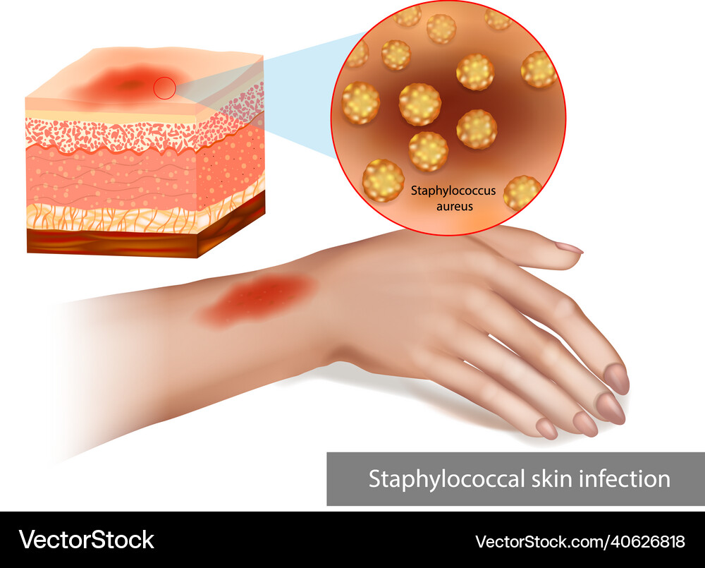 Staphylococcal skin infection or staph Royalty Free Vector