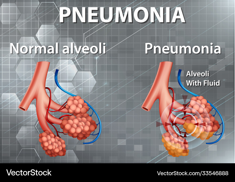 Human anatomy showing pneumonia Royalty Free Vector Image