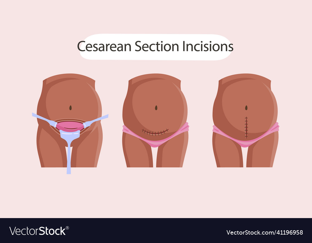 Hand drawn flat design cesarean section Royalty Free Vector