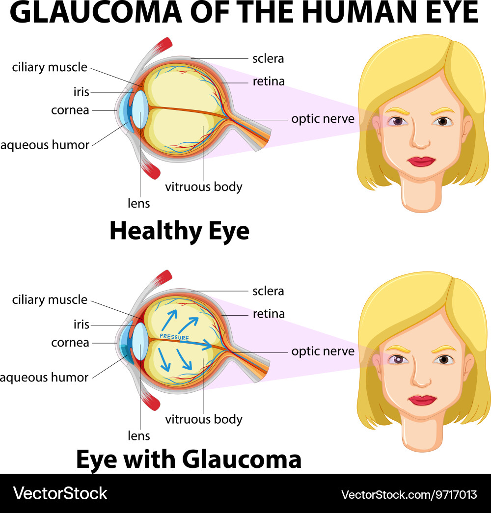 Glaucoma of the human eye Royalty Free Vector Image