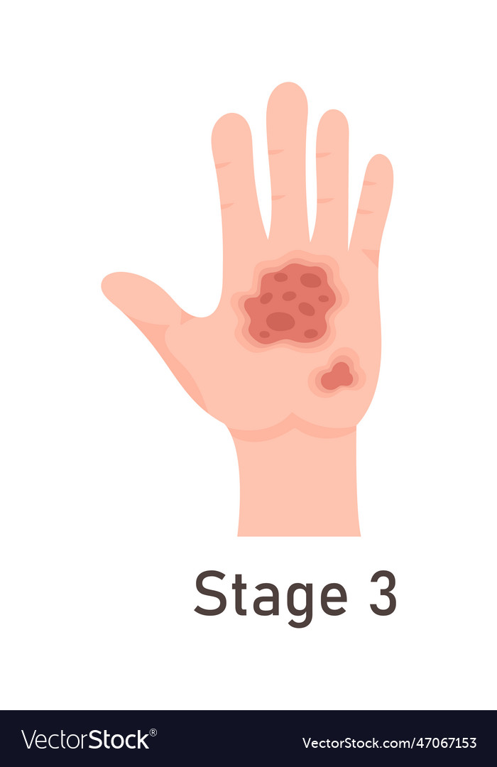 3rd Degree Of Skin Burn Royalty Free Vector Image