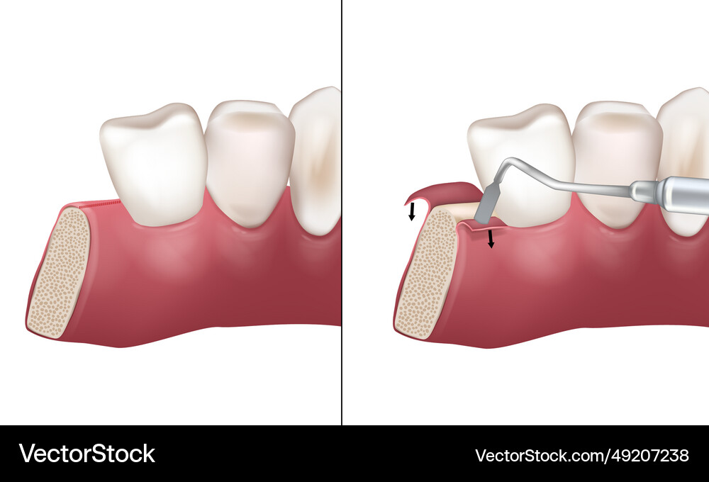 Mid-crestal incision used during implant bed Vector Image
