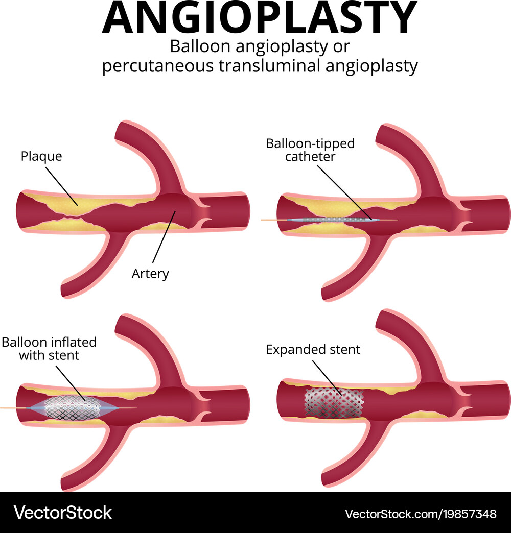 Angioplasty Procedure Stages Royalty Free Vector Image
