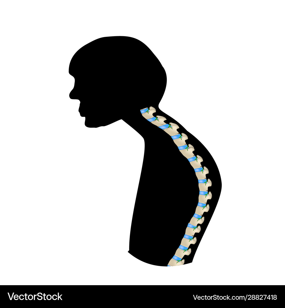 Position spine with kyphosis black Royalty Free Vector Image