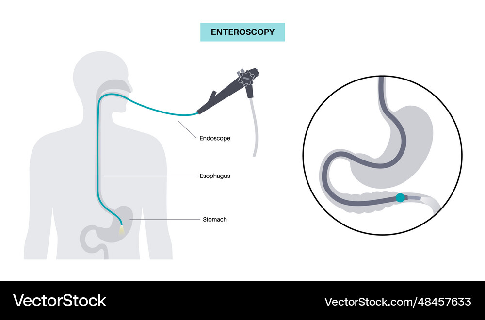 Esophagogastroduodenoscopy medical procedure Vector Image