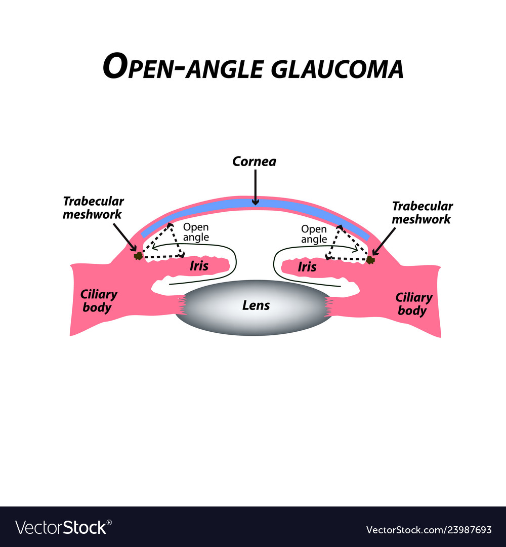 Open-angle glaucoma a common type of glaucoma Vector Image Open-angle glaucoma a common type of glaucoma Vector Image