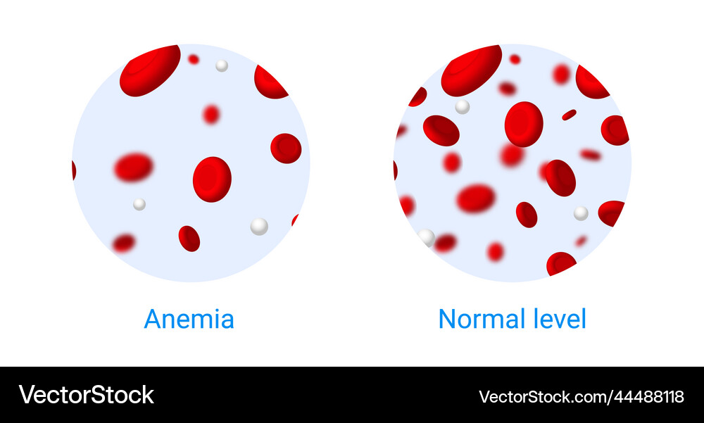 Anemia problem circulatory iron body diagram Vector Image