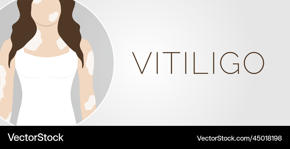 Vitiligo skin condition banner background Vector Image