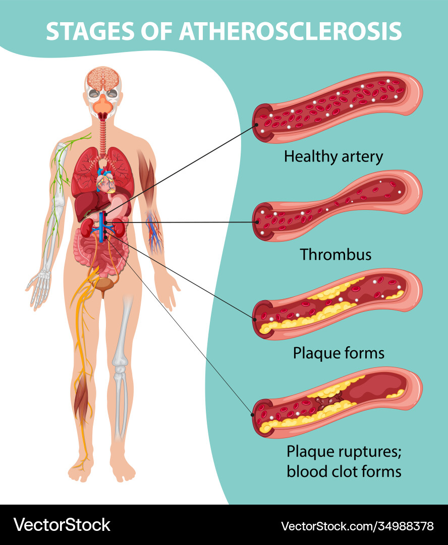 Stages atherosclerosis information infographic Vector Image