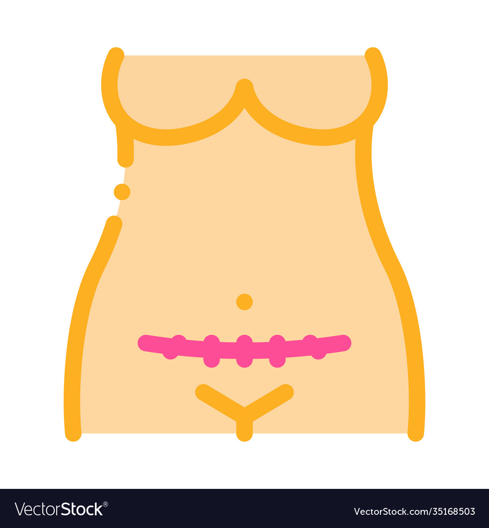 Cesarean section color icon Royalty Free Vector Image