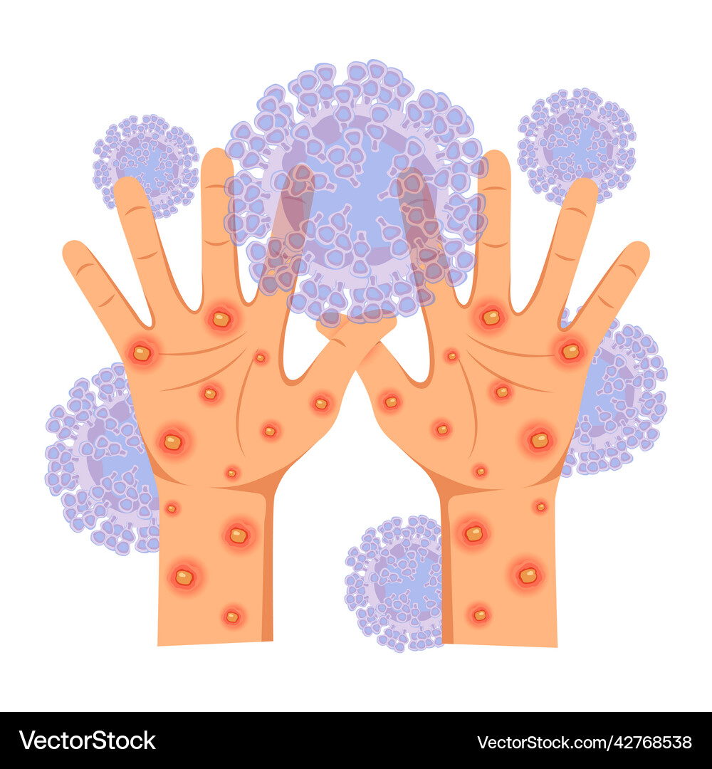 Human hands affected by a rash purulent ulcers Vector Image