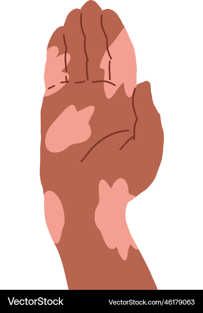Hand with palm open brown skin with vitiligo patch