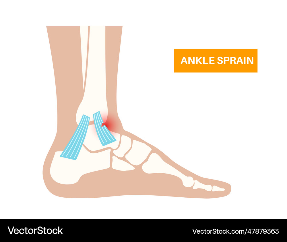 Sprained Ankle Injury Anatomy Royalty Free Vector Image
