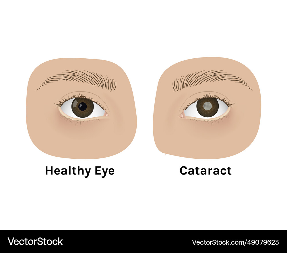 Realistic human healthy eye and with cataract Vector Image