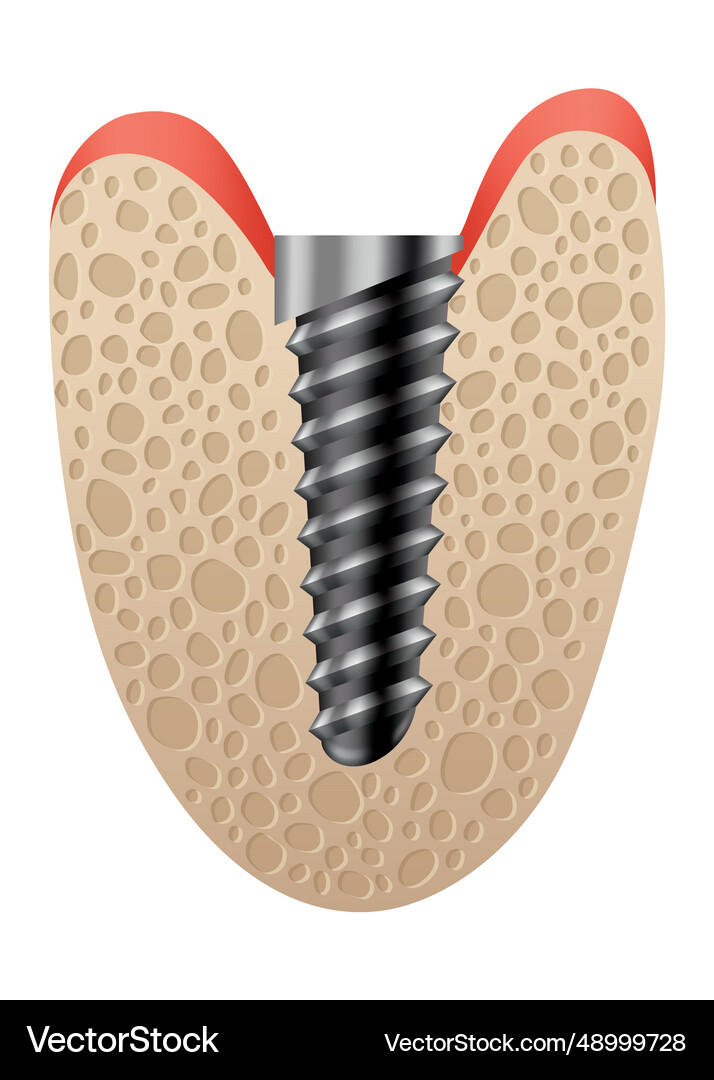 Dental implant structure medical educative Vector Image