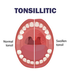 Tonsil Vector Images (over 250)