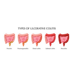 Ulcerative colitis treatment diet infographic Vector Image
