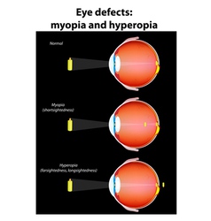 Optical human eye defects myopia and hyperopia Vector Image