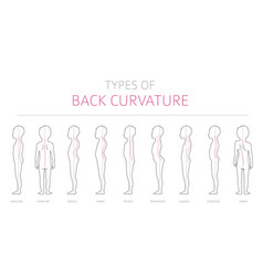Types of back curvature medical desease Royalty Free Vector