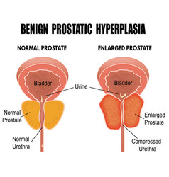 Benign prostatic hyperplasia Royalty Free Vector Image