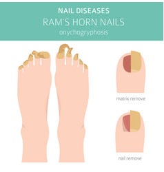 Nail diseases onychocryptocosis ingrown toenail Vector Image