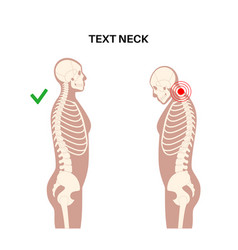 Neck vertebrae deformity Royalty Free Vector Image