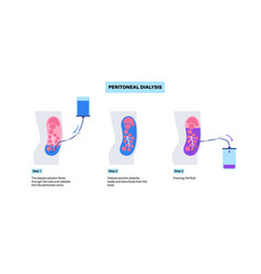 Peritoneal dialysis concept Royalty Free Vector Image
