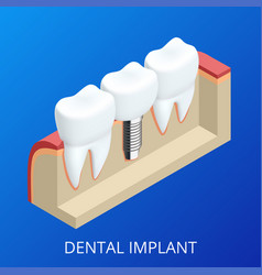 Dental teeth implant implantation procedure or Vector Image