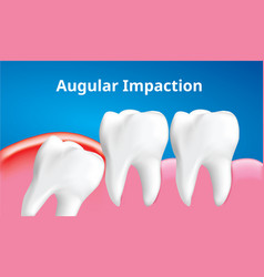 Wisdom tooth angular or mesial impaction Vector Image