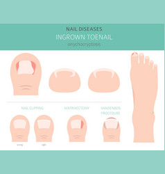 Nail diseases onychocryptocosis ingrown toenail Vector Image