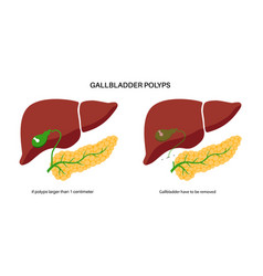 Gallbladder anatomy poster Royalty Free Vector Image