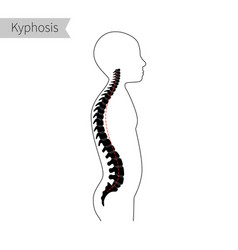 Kyphosis flat Royalty Free Vector Image - VectorStock